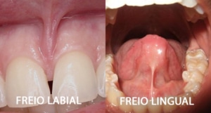 Você sabe como ocorre a cirurgia de freio labial? Veja aqui! - CCO
